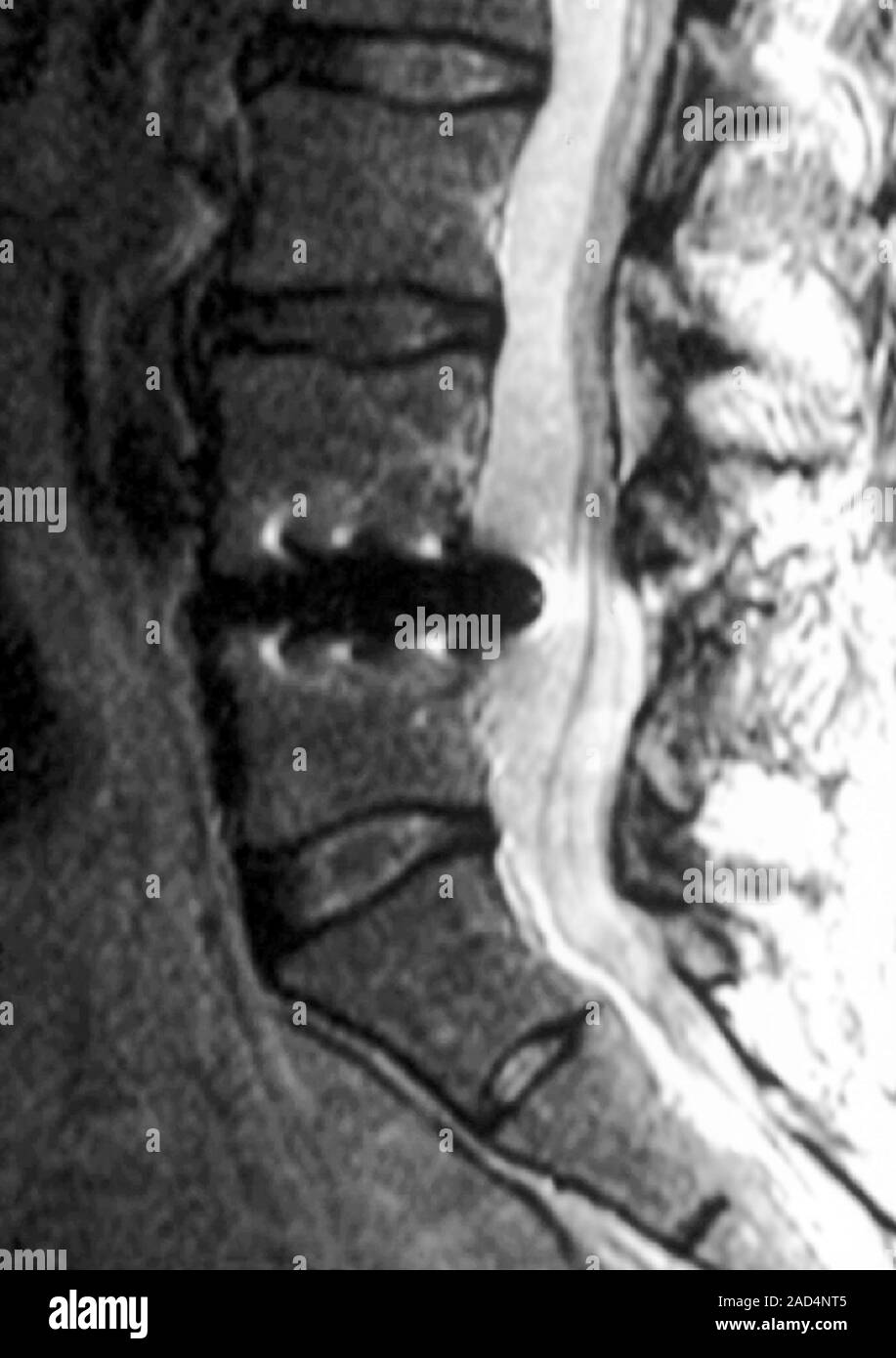 Spinal disc replacement. Magnetic resonance imaging (MRI) scan of a ...