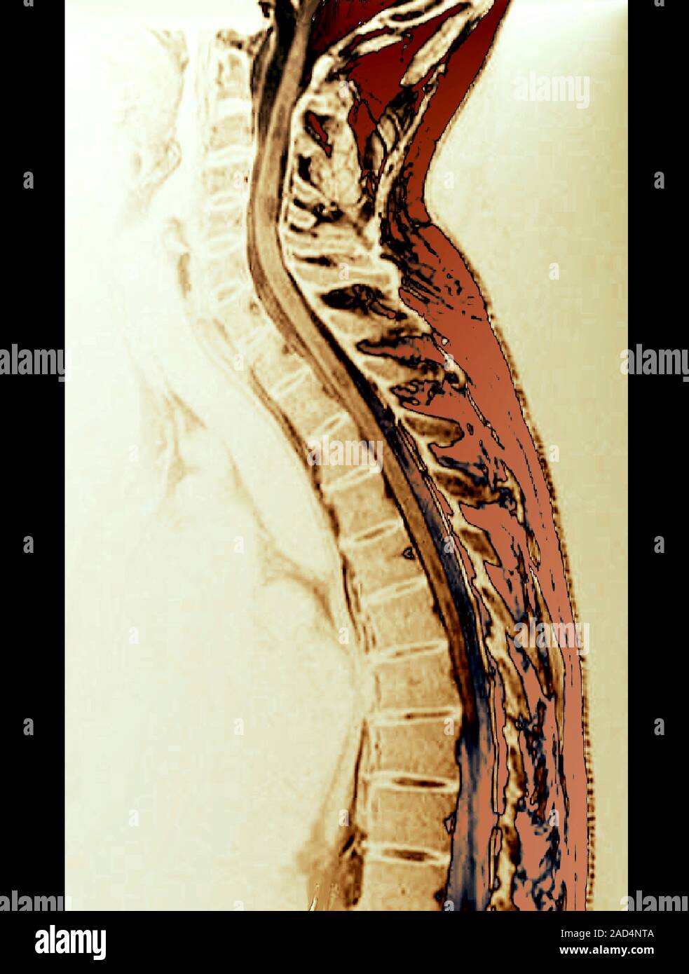 Spine in multiple sclerosis. Coloured magnetic resonance imaging (MRI) scan of a section through ...