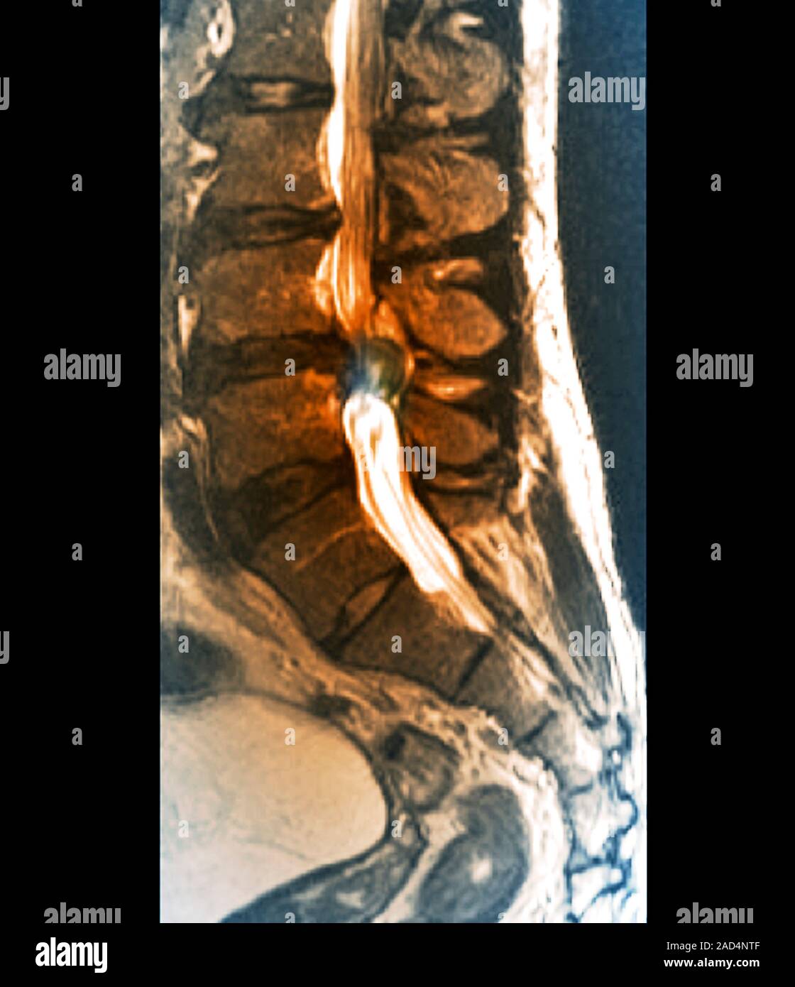 Slipped disc. Coloured frontal computed tomography (CT) scan of a ...
