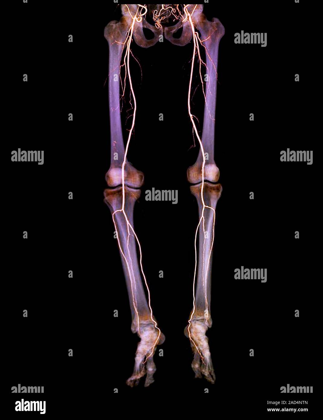 Normal leg blood vessels. Coloured 3D computed tomography (CT ...