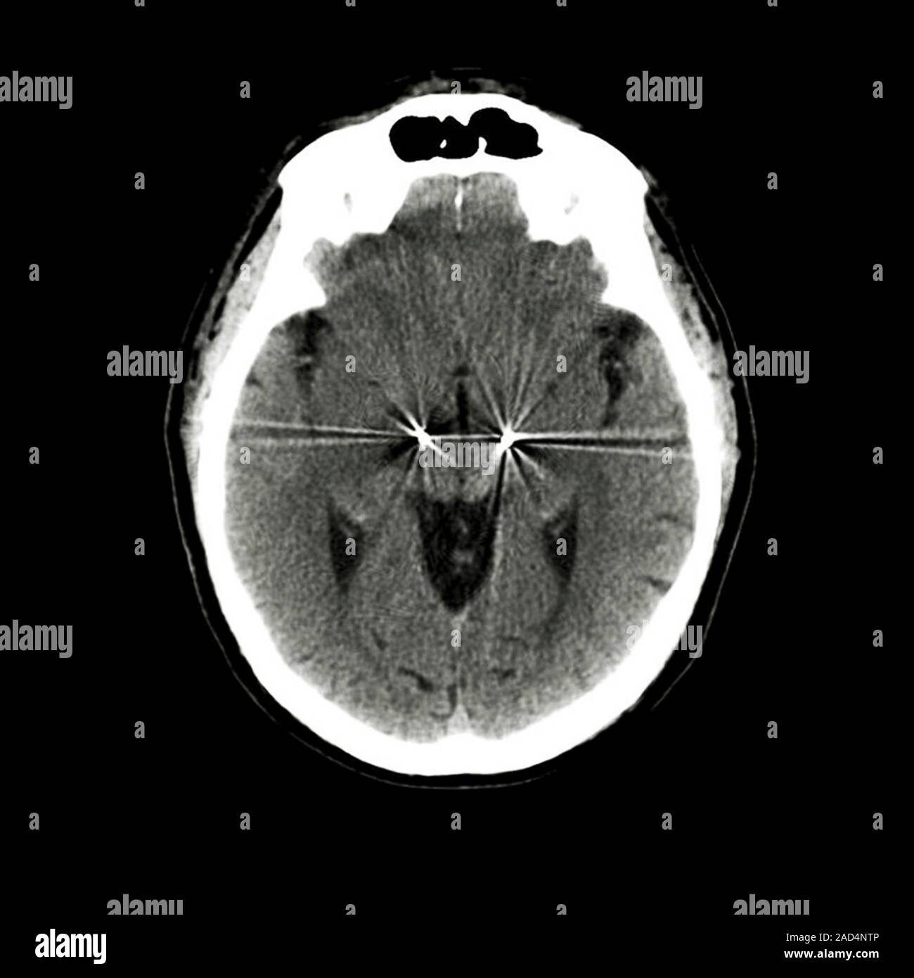Parkinson's brain pacemaker. Computed tomography (CT) scan of an axial ...