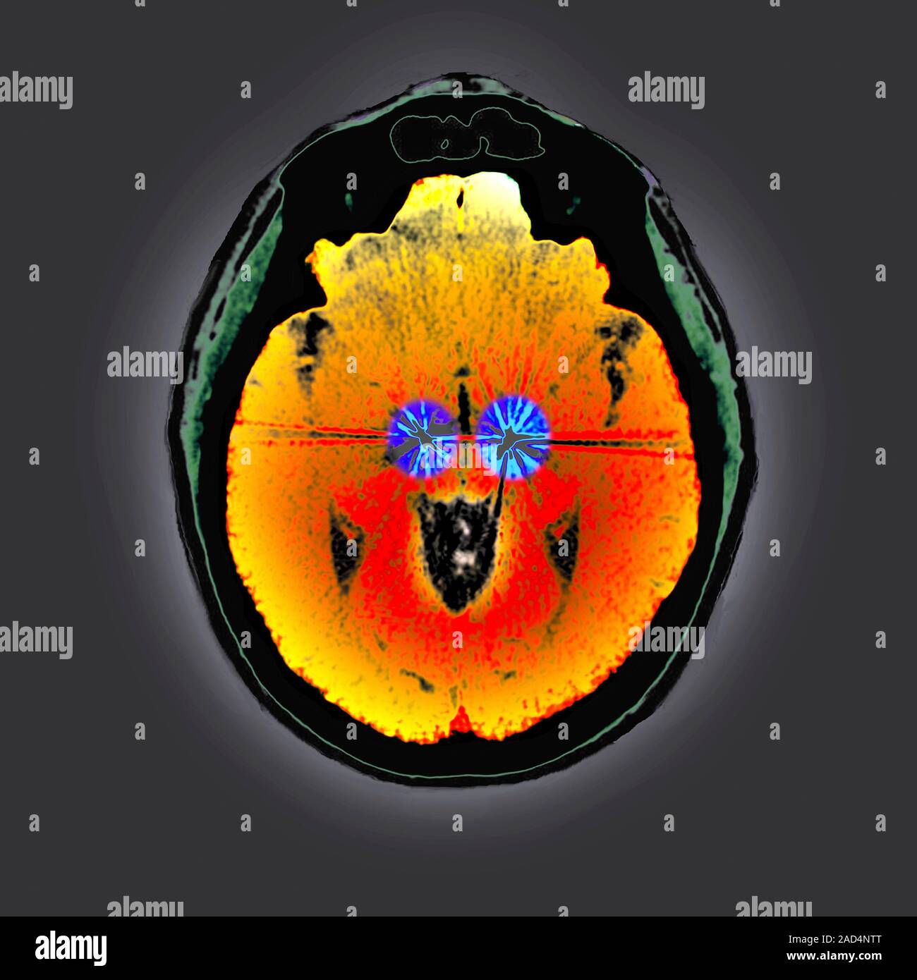 Parkinson's brain pacemaker. Coloured computed tomography (CT) scan of ...