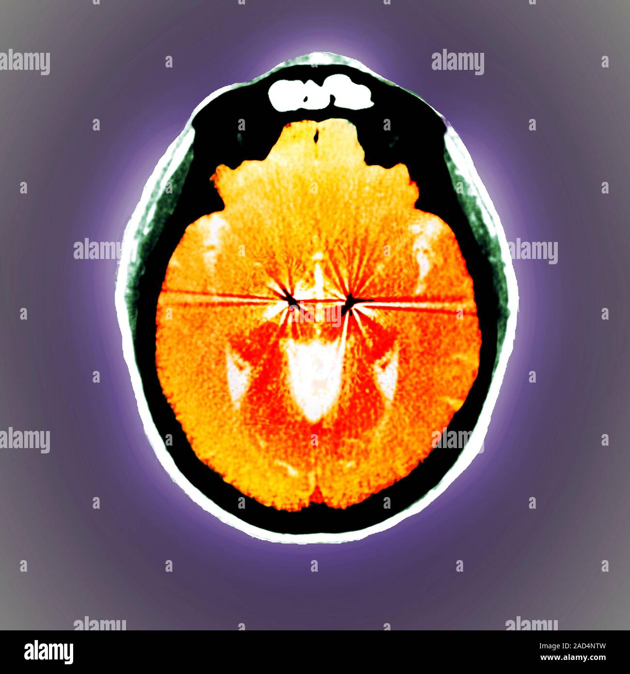 Parkinson's brain pacemaker. Computed tomography (CT) scan of an axial ...