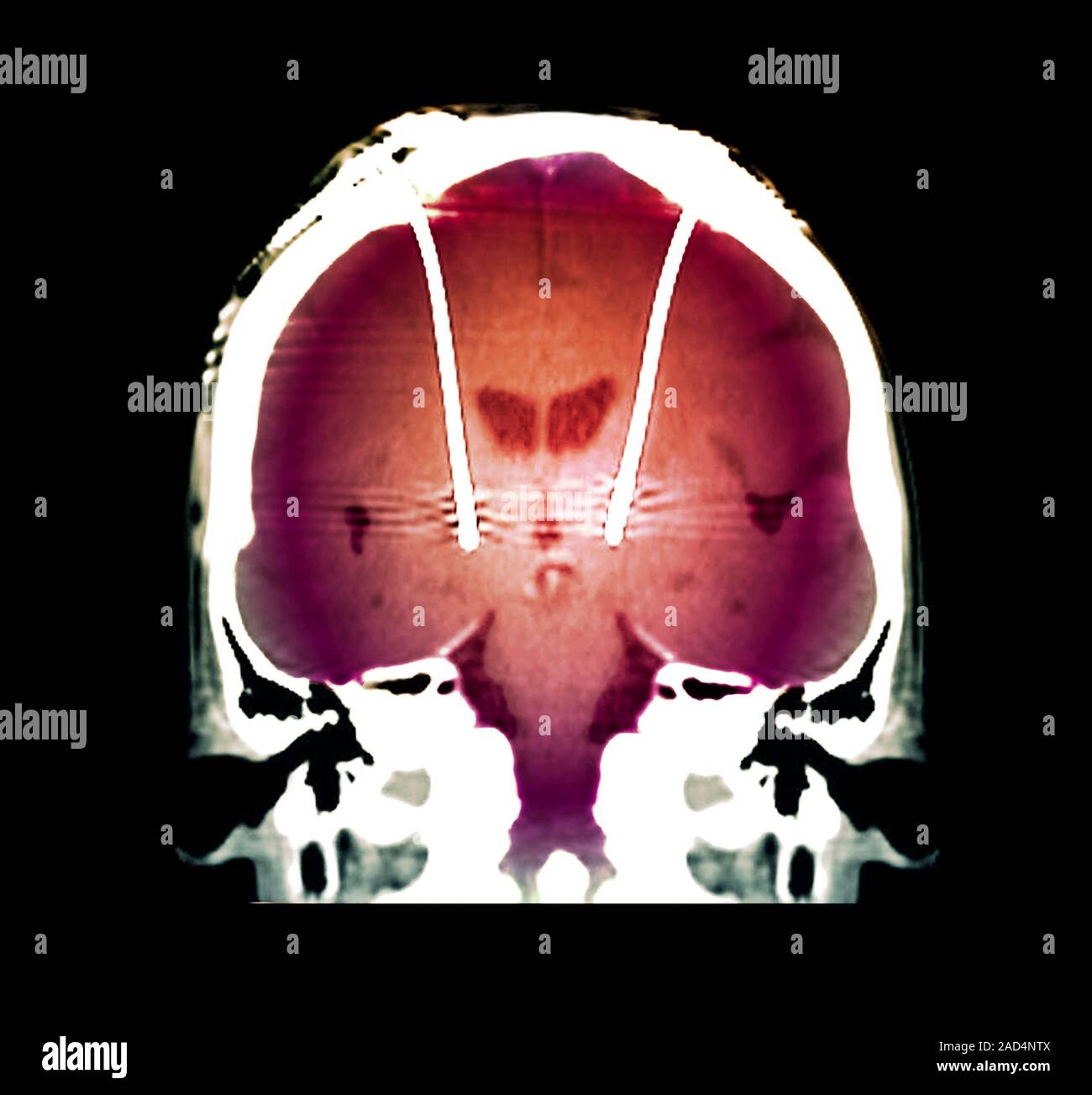 Parkinson's brain pacemaker. Coloured frontal computed tomography (CT ...