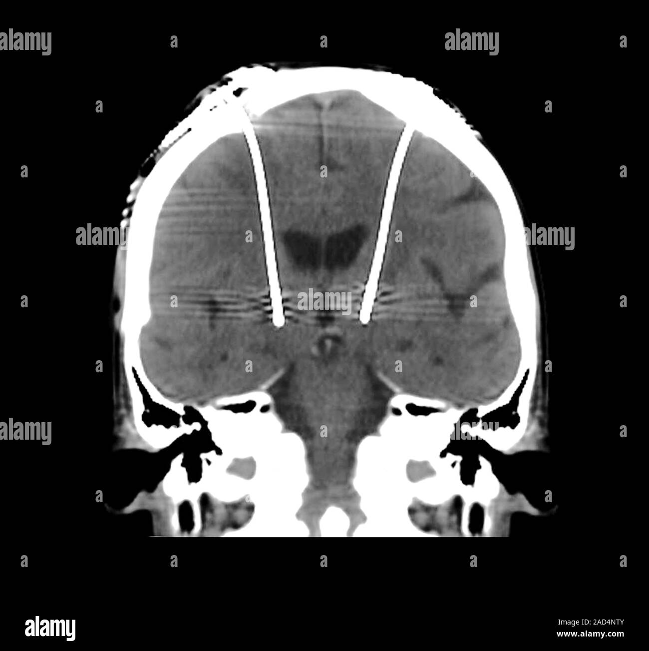 Parkinson's brain pacemaker. Frontal computed tomography (CT) scan of a ...