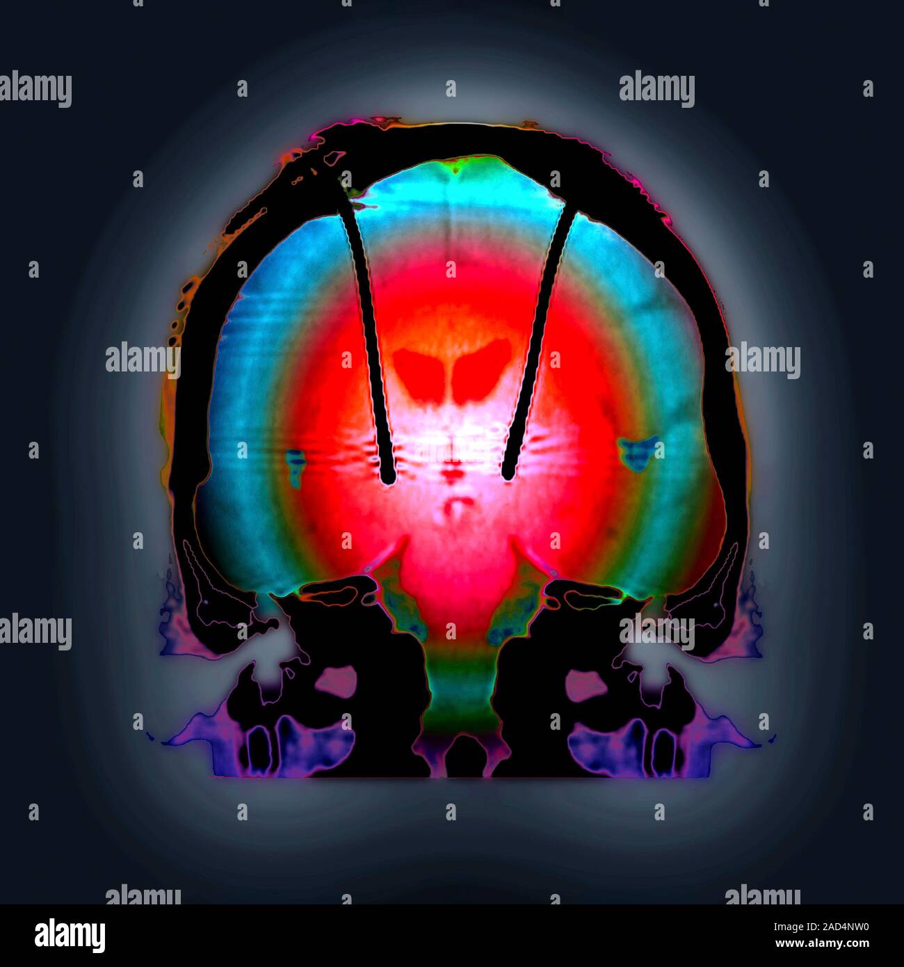 Parkinson's brain pacemaker. Coloured frontal computed tomography (CT ...