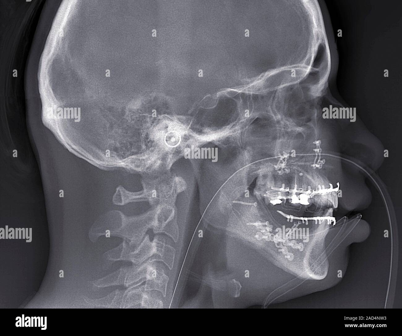 Skull after reconstructive surgery. X-ray of a section through the ...