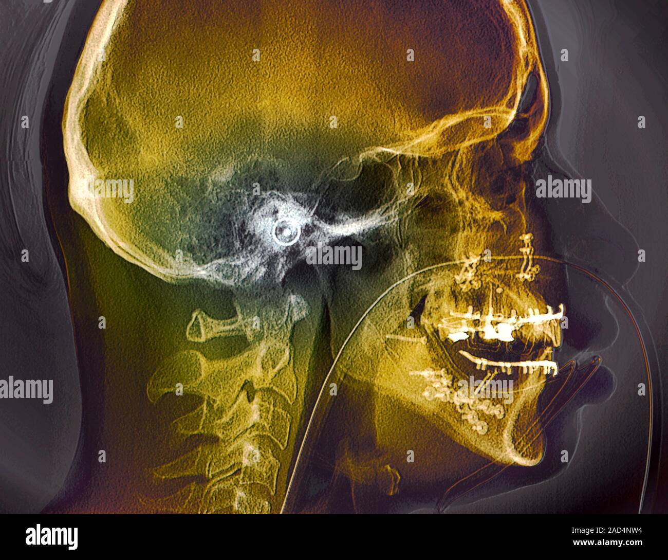 Skull after reconstructive surgery. Coloured X-ray of a section through ...