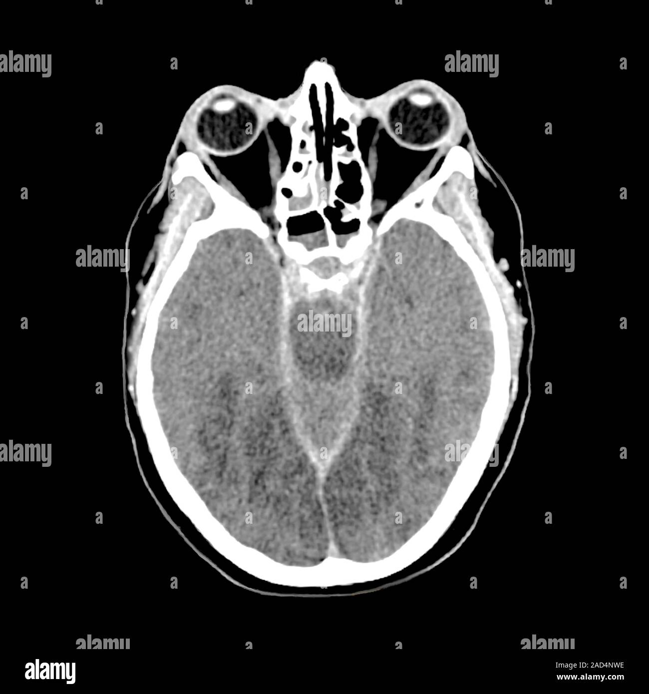 Brain death following cardiac arrest. Computed tomography (CT) scan of ...
