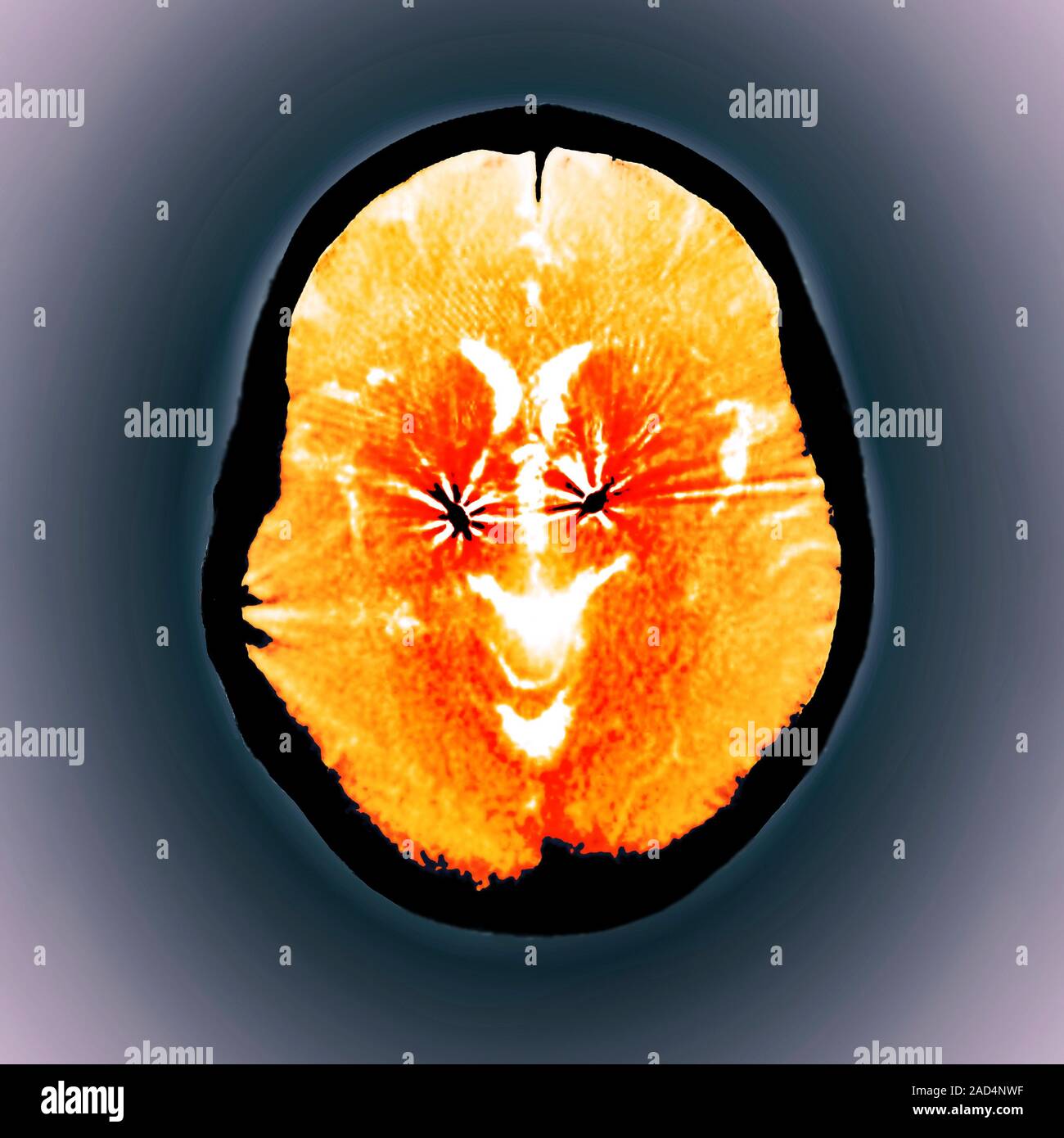 Parkinson's brain pacemaker. Coloured computed tomography (CT) scan of ...