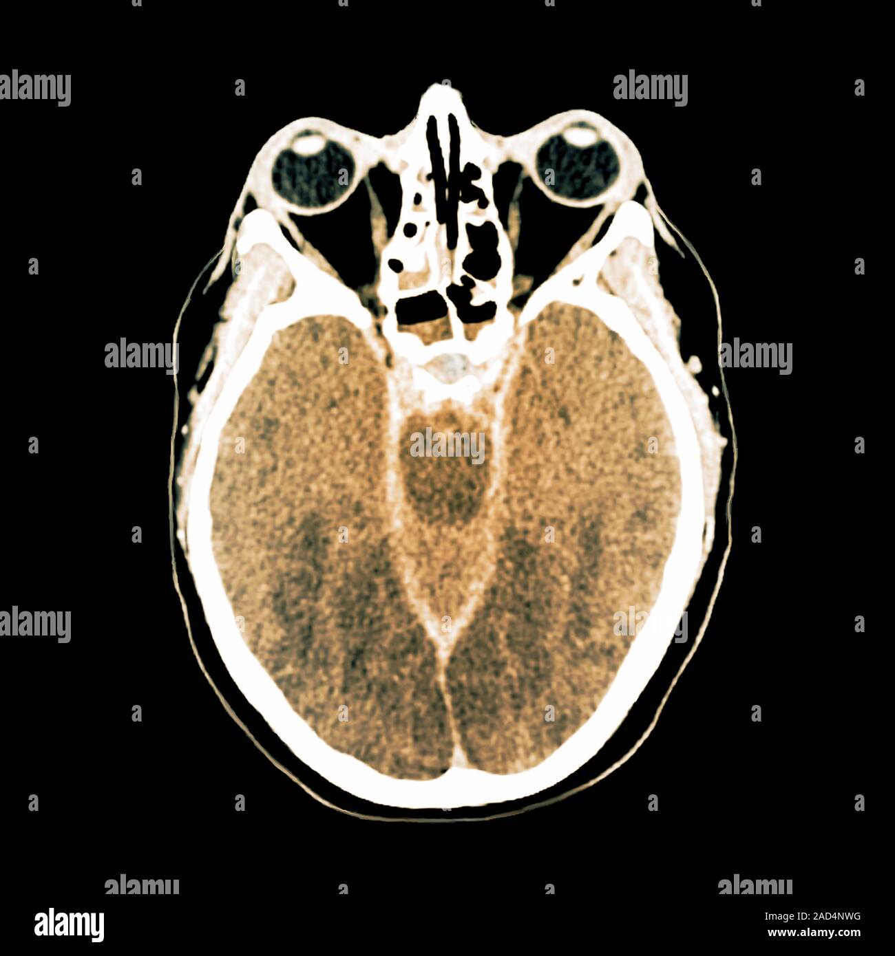 Brain death following cardiac arrest. Coloured computed tomography (CT) scan of an axial section ...