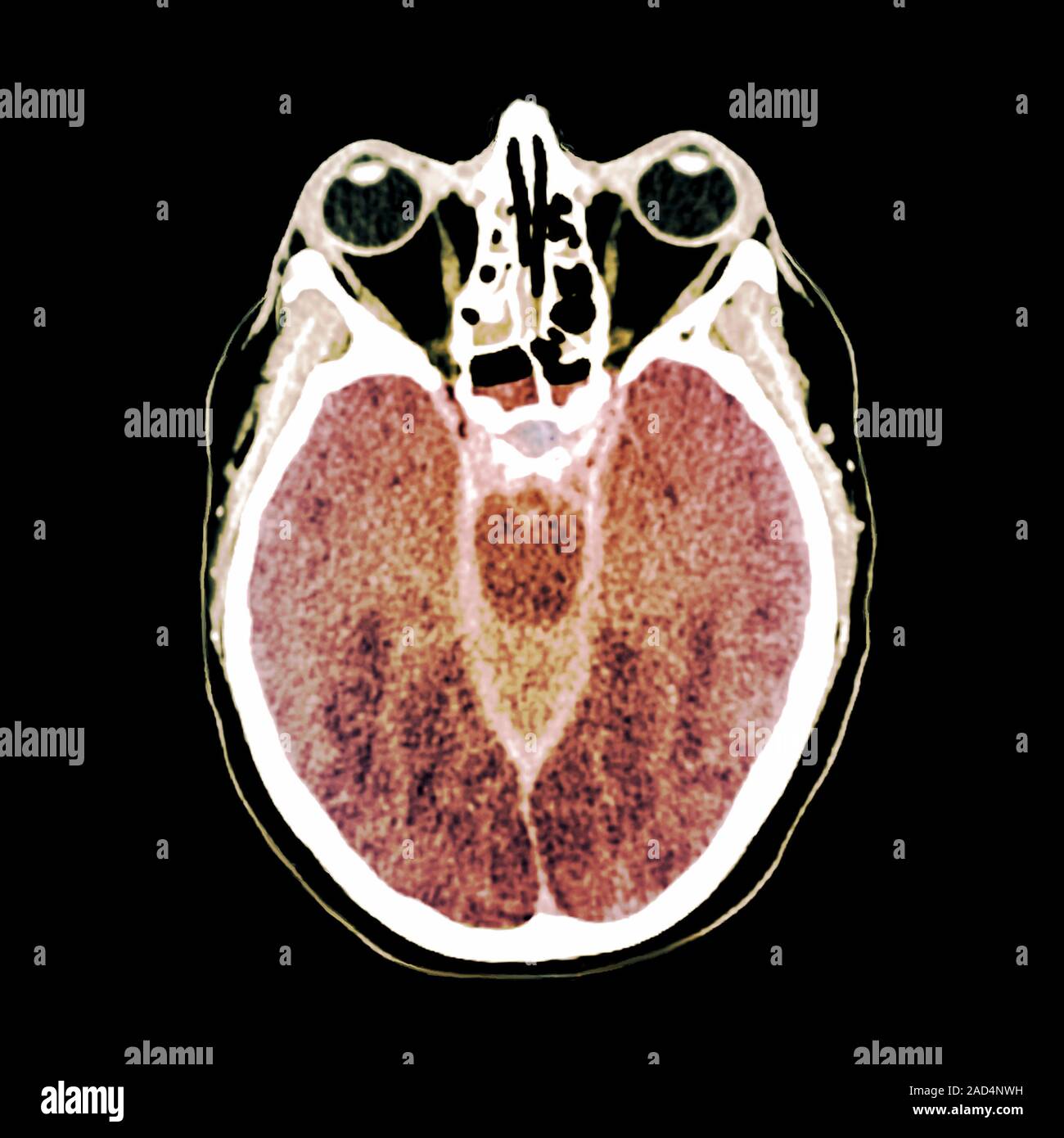 Brain death following cardiac arrest. Coloured computed tomography (CT) scan of an axial section ...