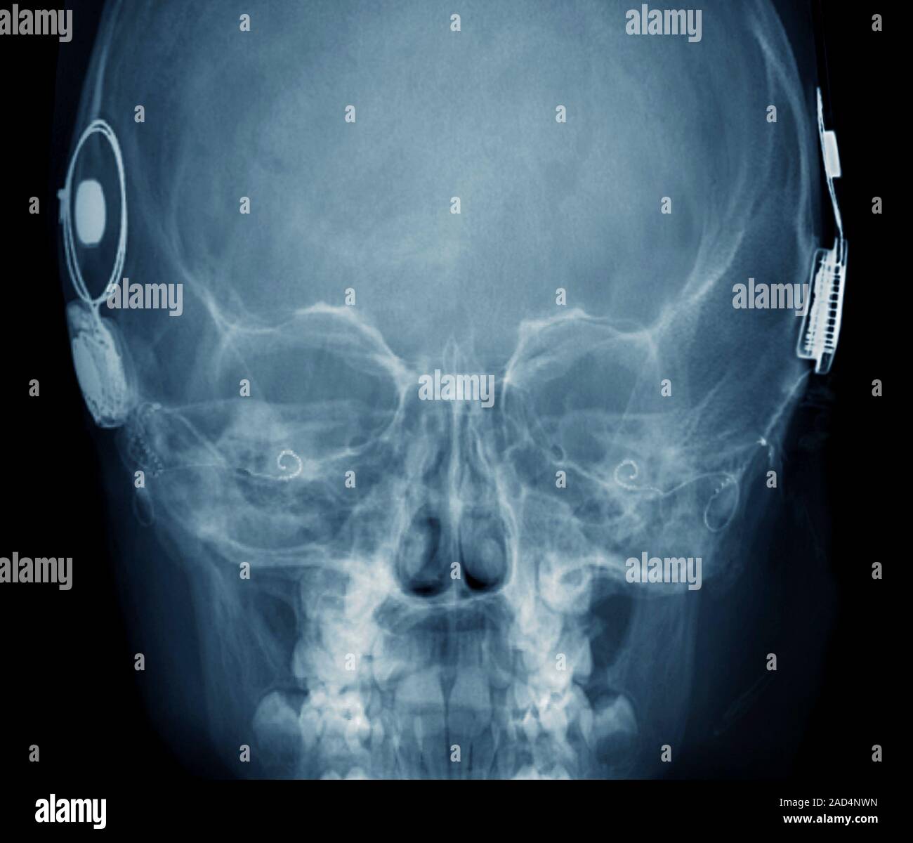 Cochlear implants. X-ray of a section through the head of a 14-year-old ...