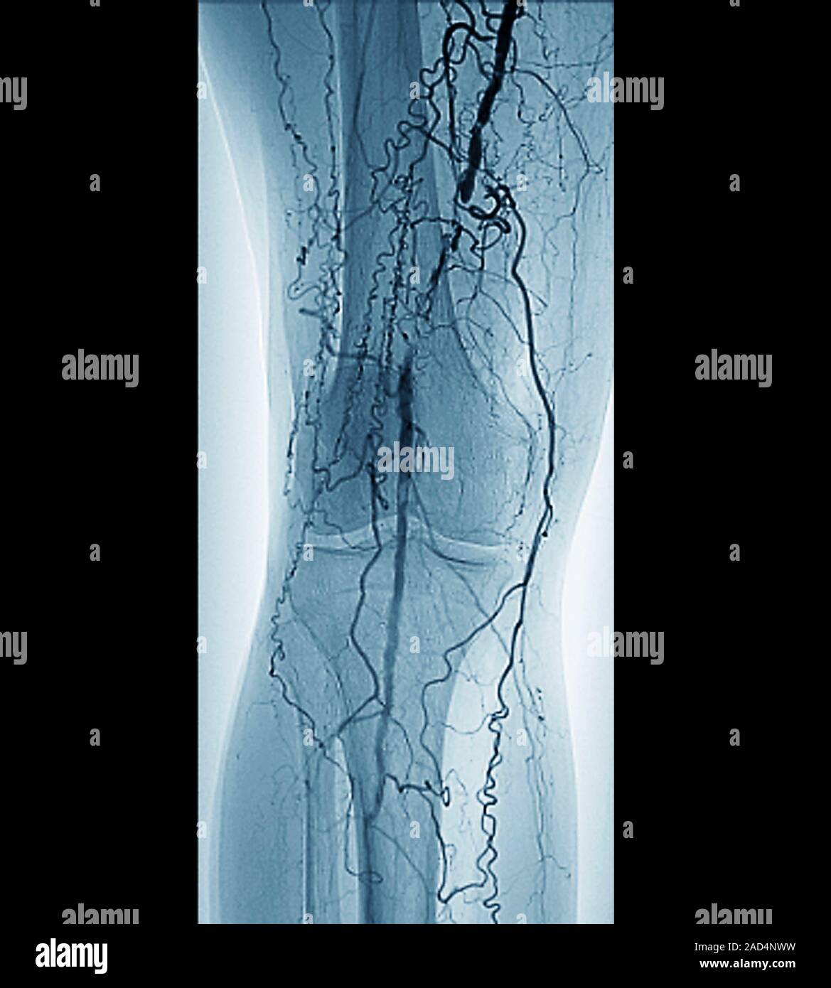 Peripheral vascular disease in diabetes. Angiogram of the right leg of ...