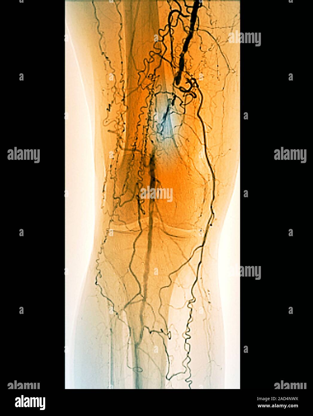 Peripheral vascular disease in diabetes. Angiogram of the right leg of ...