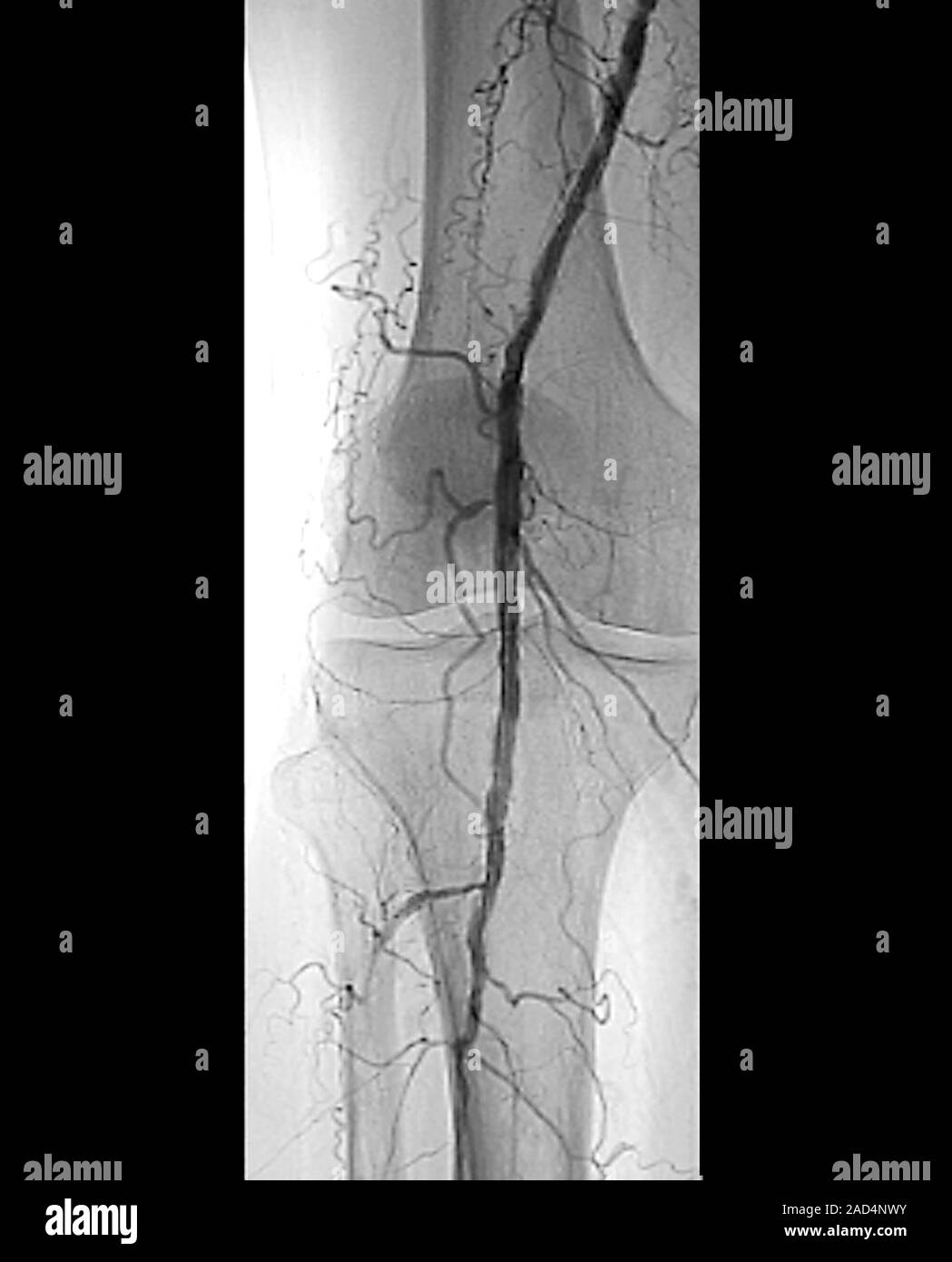 Peripheral vascular disease in diabetes. Angiogram of the right leg of ...