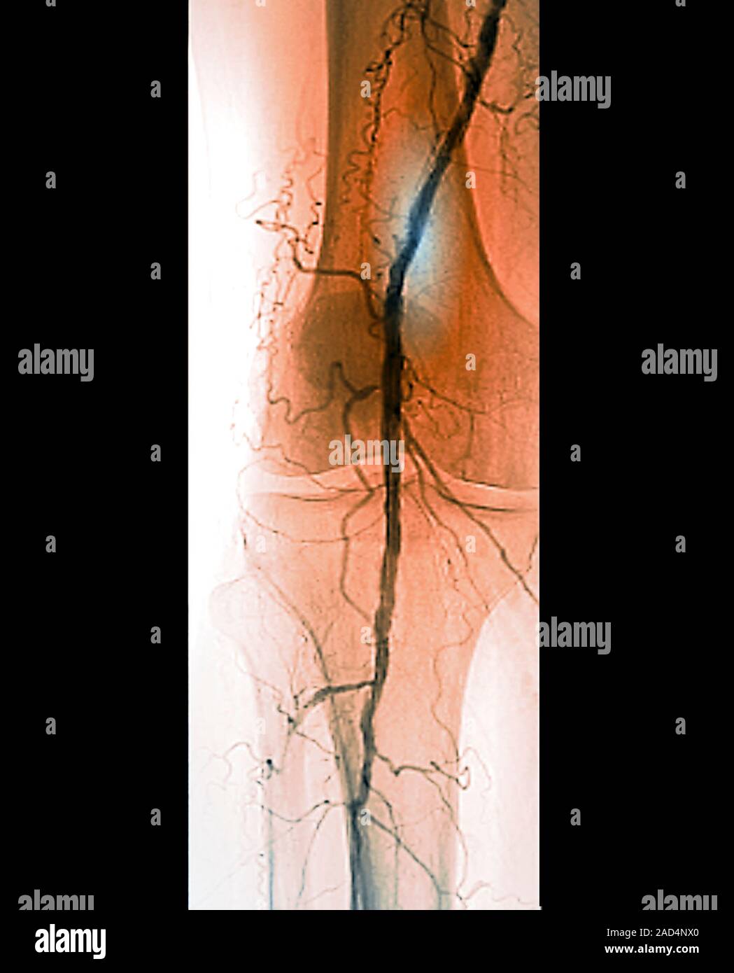 Peripheral vascular disease in diabetes. Angiogram of the right leg of ...