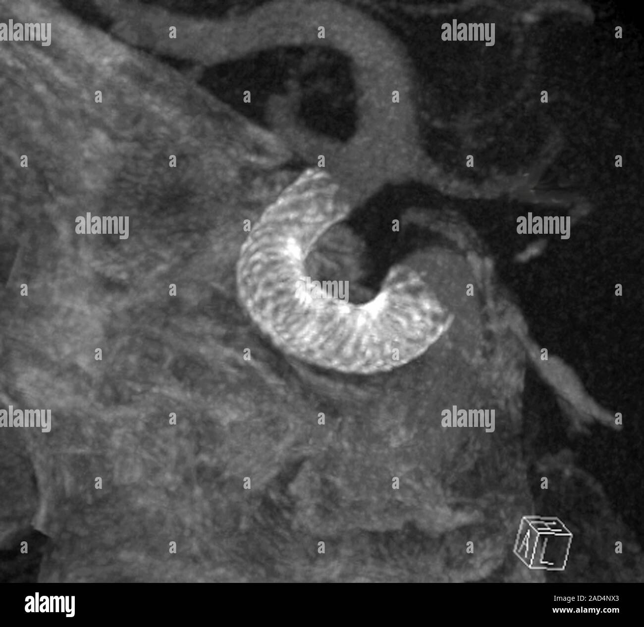 Stent in carotid aneurysm. 3D computed tomography (CT) scan of the neck ...