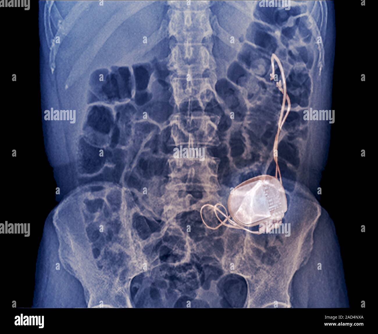 Gastric pacemaker in gastroparesis. Coloured X-ray of a section through ...