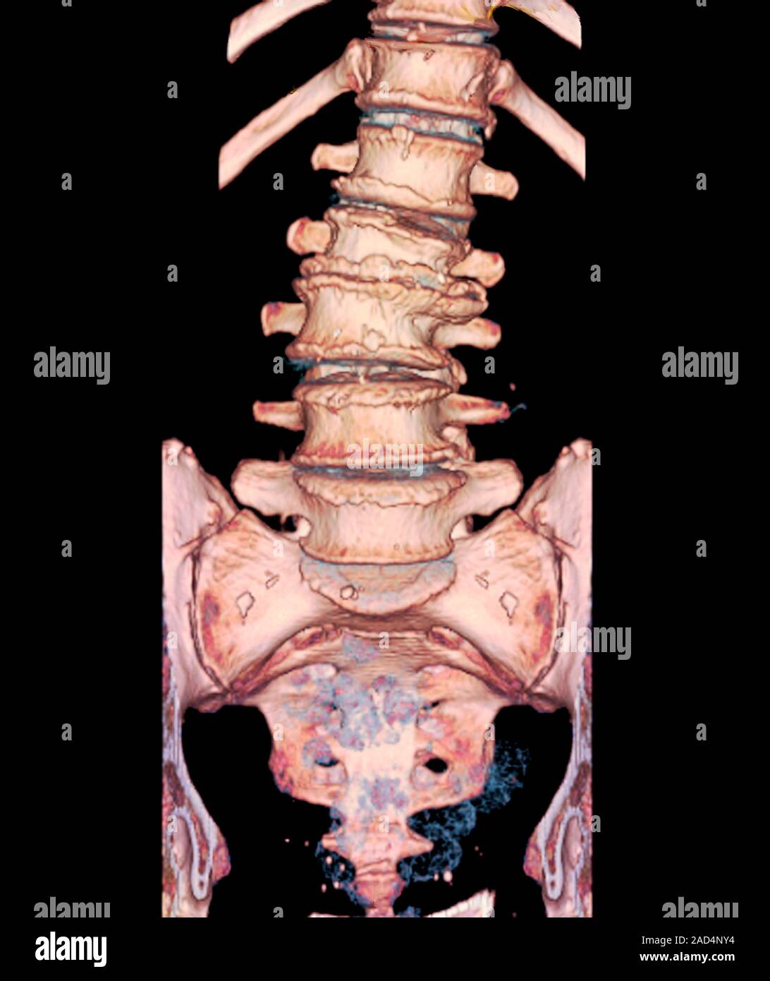 Spinal Compression Fracture Coloured 3d Computed Tomography Ct Scan Of The Lumbar Spine Of A