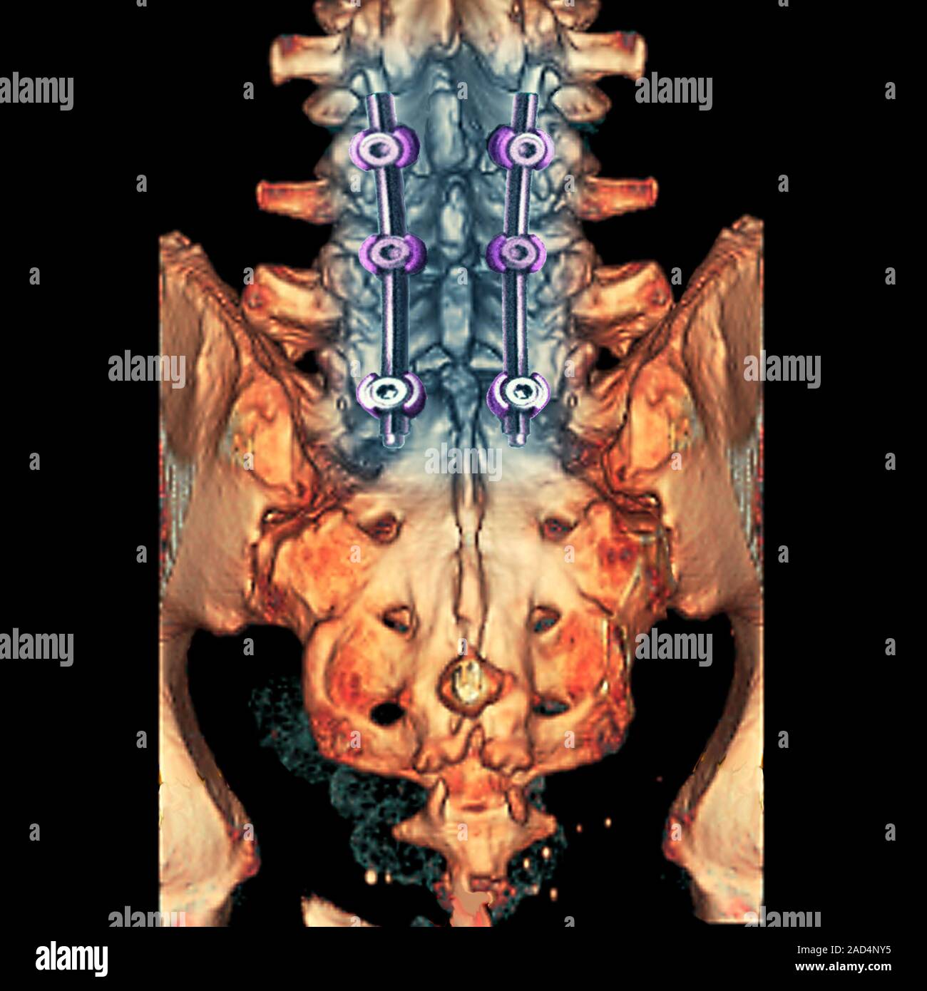 Fixed spinal fracture. Coloured 3D computed tomography (CT) scan of the lumbosacral spine of a ...
