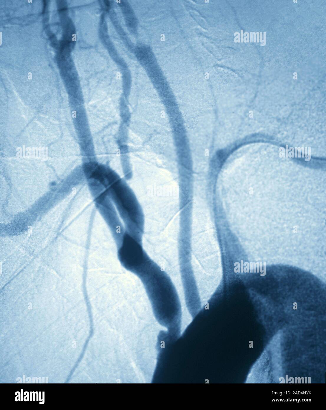 Vascular disease in smoker. Angiogram of the supra-aortic trunks of a ...