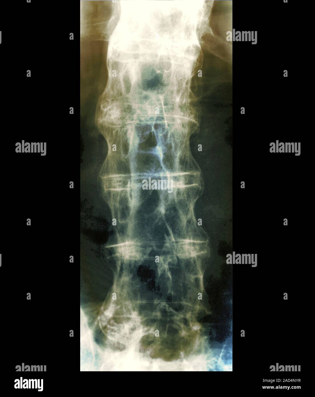 Spine in ankylosing spondylitis. Coloured X-ray of the lumbar spine of ...
