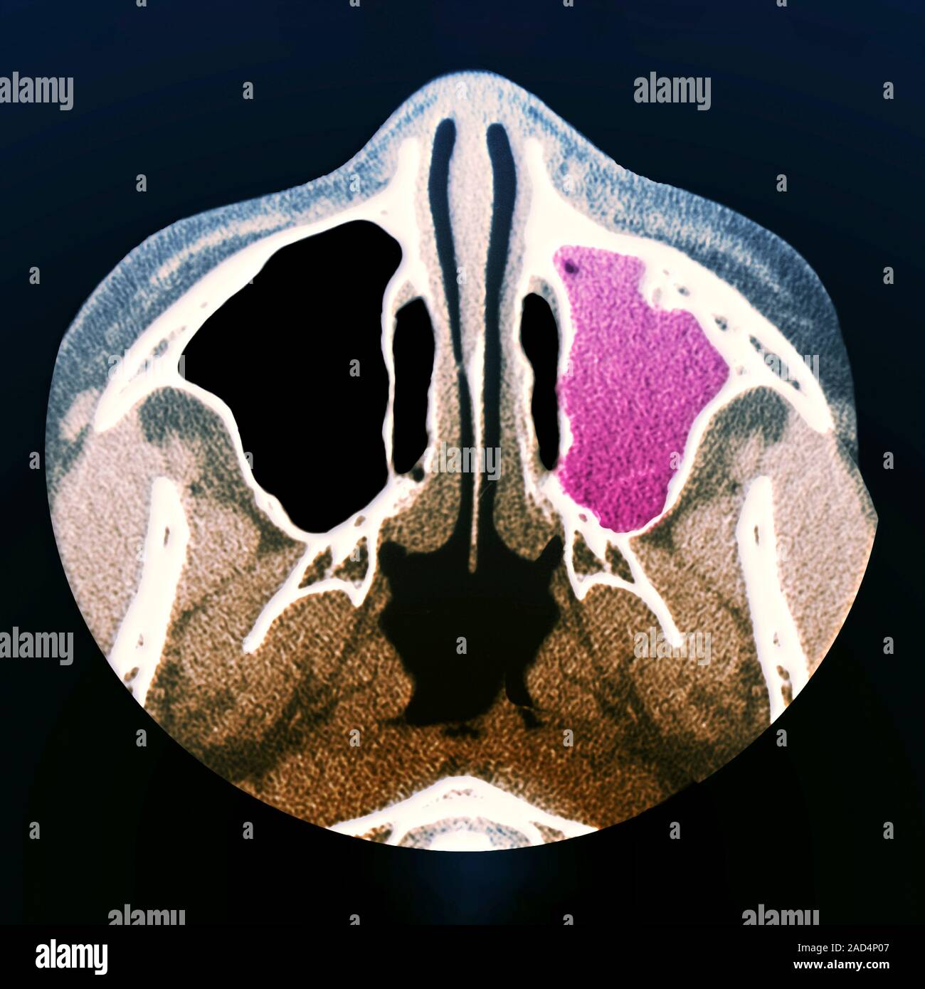 Sinus infection. Coloured computed tomography (CT) scan of a section ...
