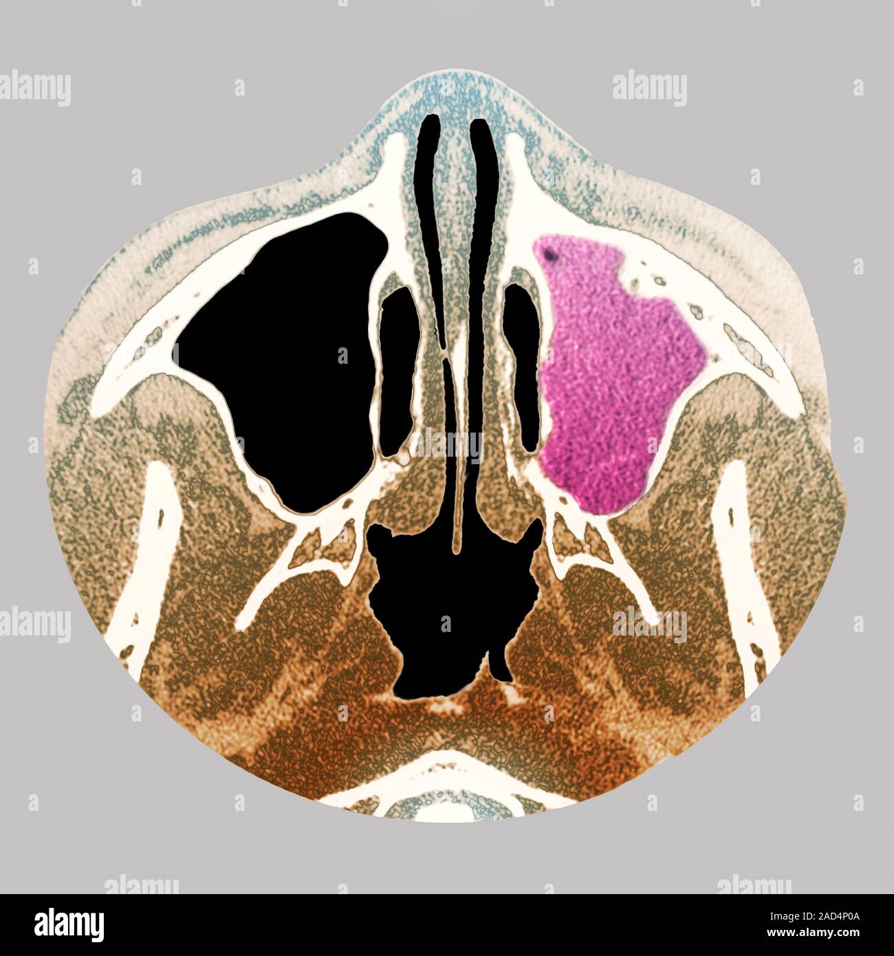Sinus infection. Coloured computed tomography (CT) scan of a section ...
