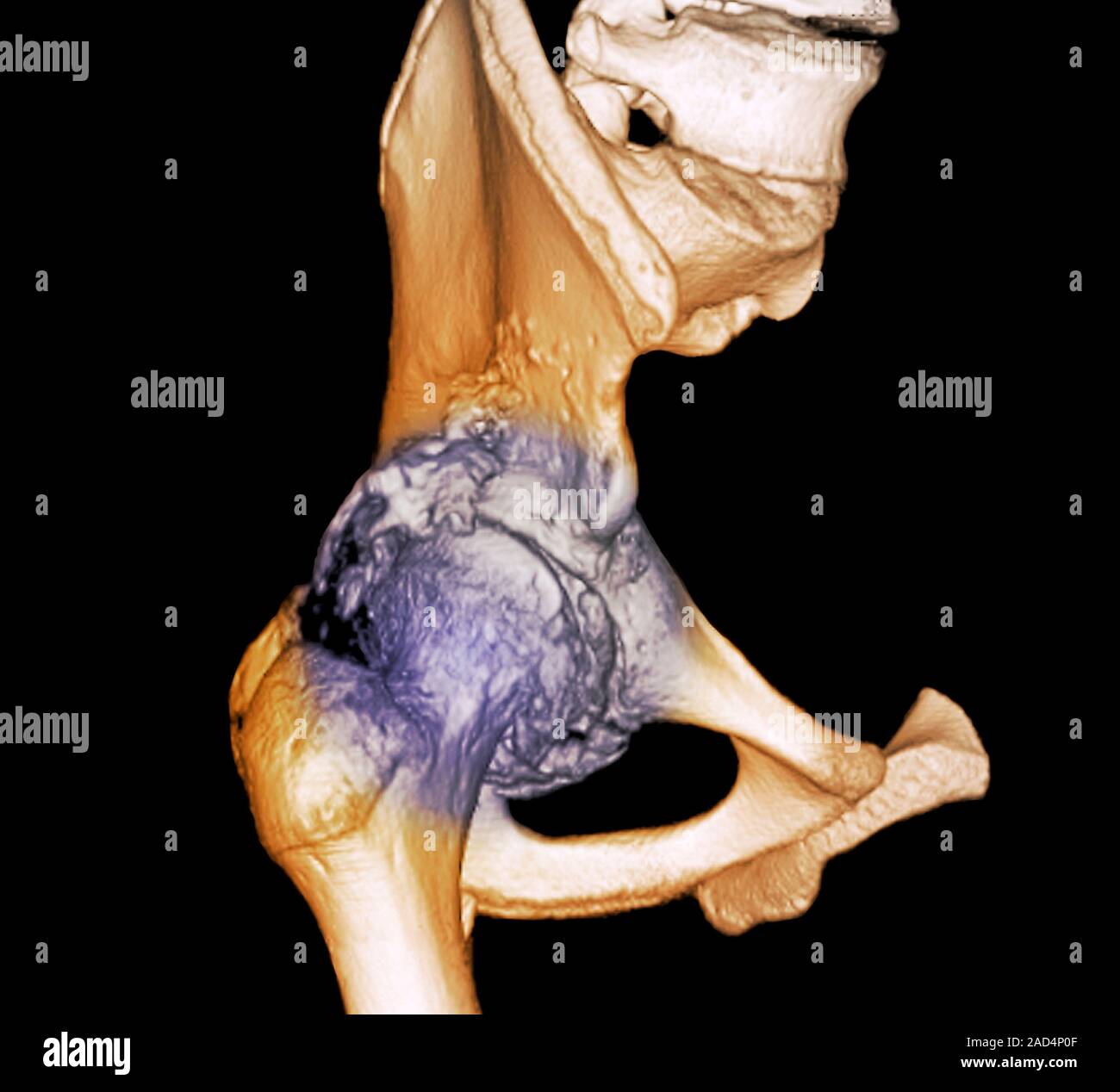 Osteoarthritis of the hip. Coloured 3D computed tomography (CT) scan of ...