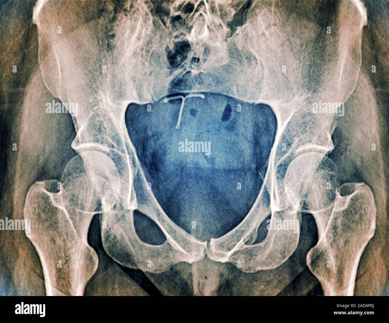 Underdeveloped pelvic bones. Coloured X-ray of a section through the ...