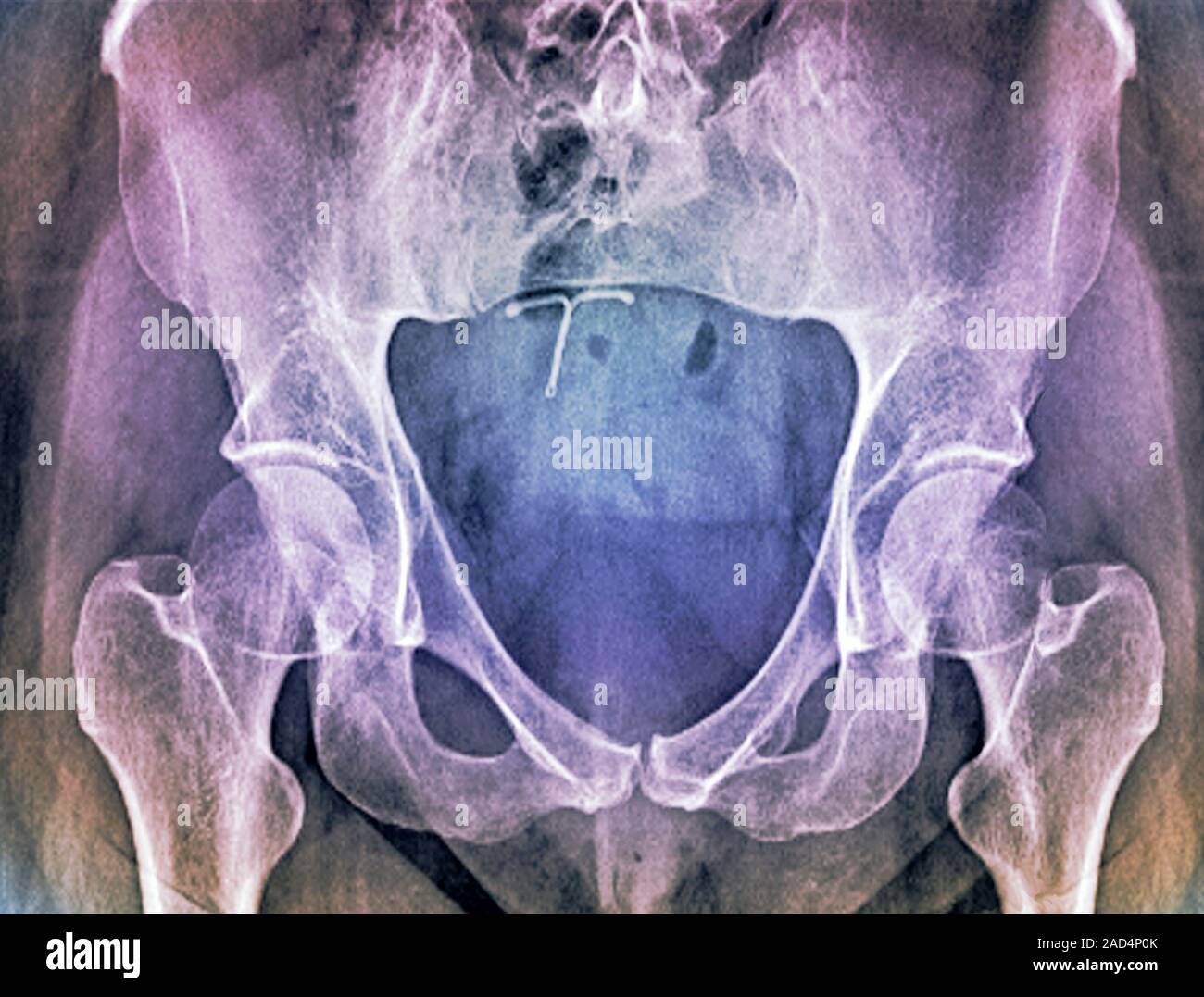 Sacrum And Coccyx X Ray