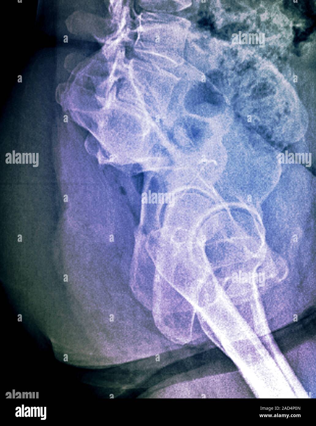 Underdeveloped pelvic bones. Coloured X-ray of a section through the ...
