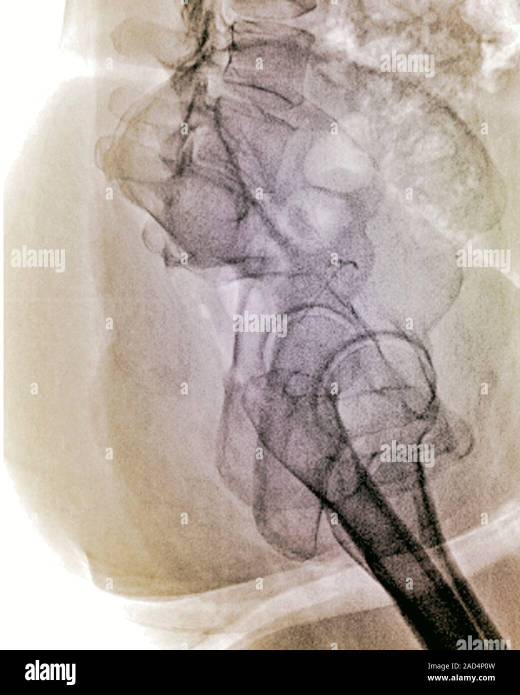 Underdeveloped pelvic bones. Coloured X-ray of a section through the ...