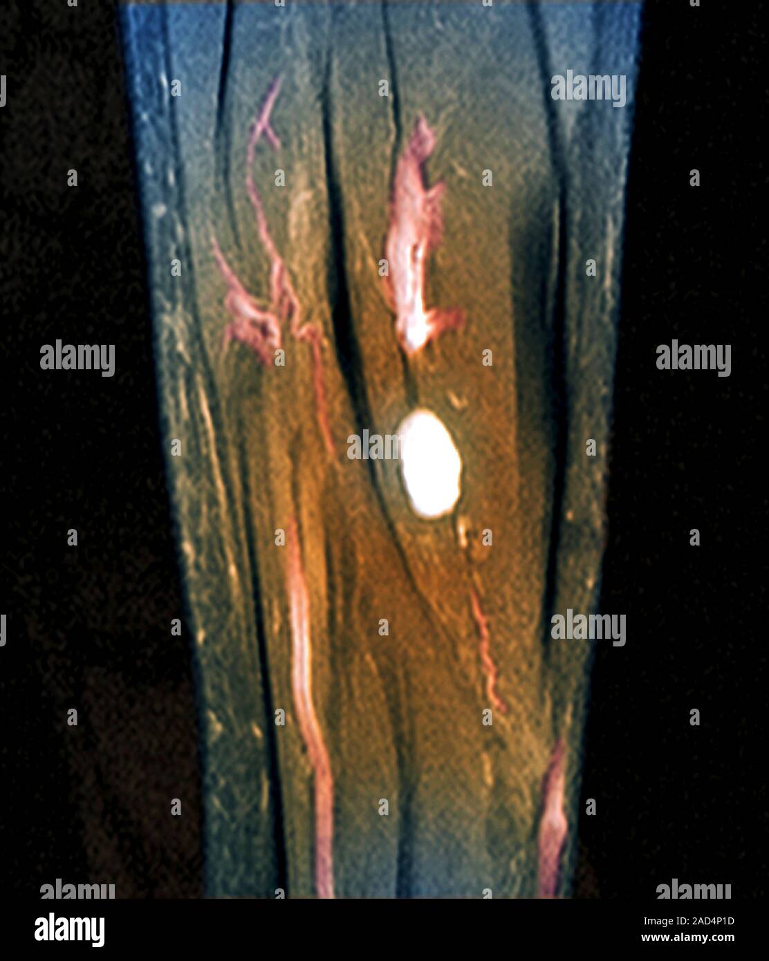 Schwannoma nerve sheath tumour. Coloured magnetic resonance imaging ...