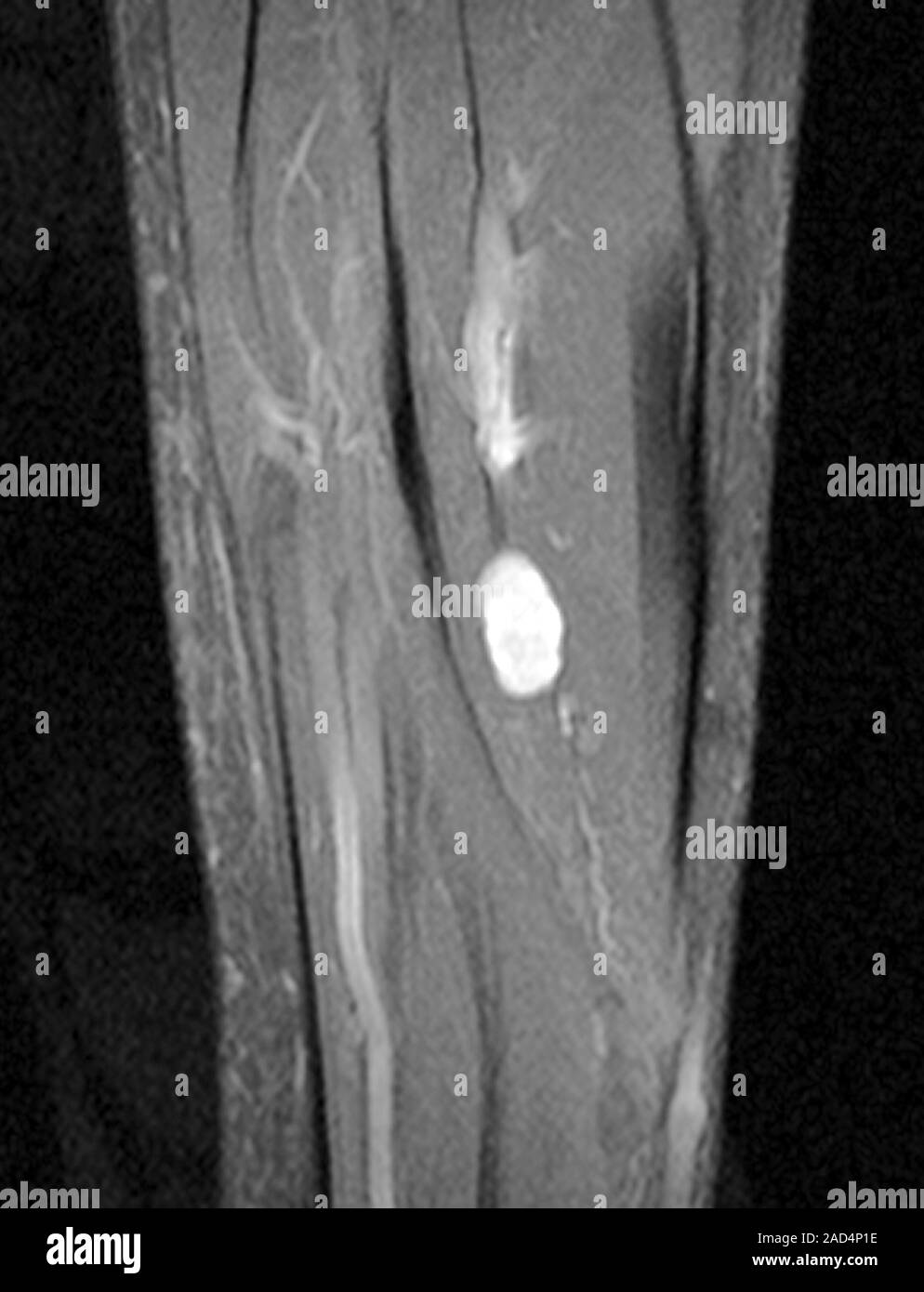Schwannoma nerve sheath tumour. Magnetic resonance imaging (MRI) scan ...