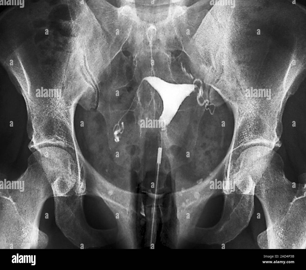 Hysterosalpingogram X Ray Of The Pelvis Of A 27 Year Old Woman Showing Her Uterus Womb White