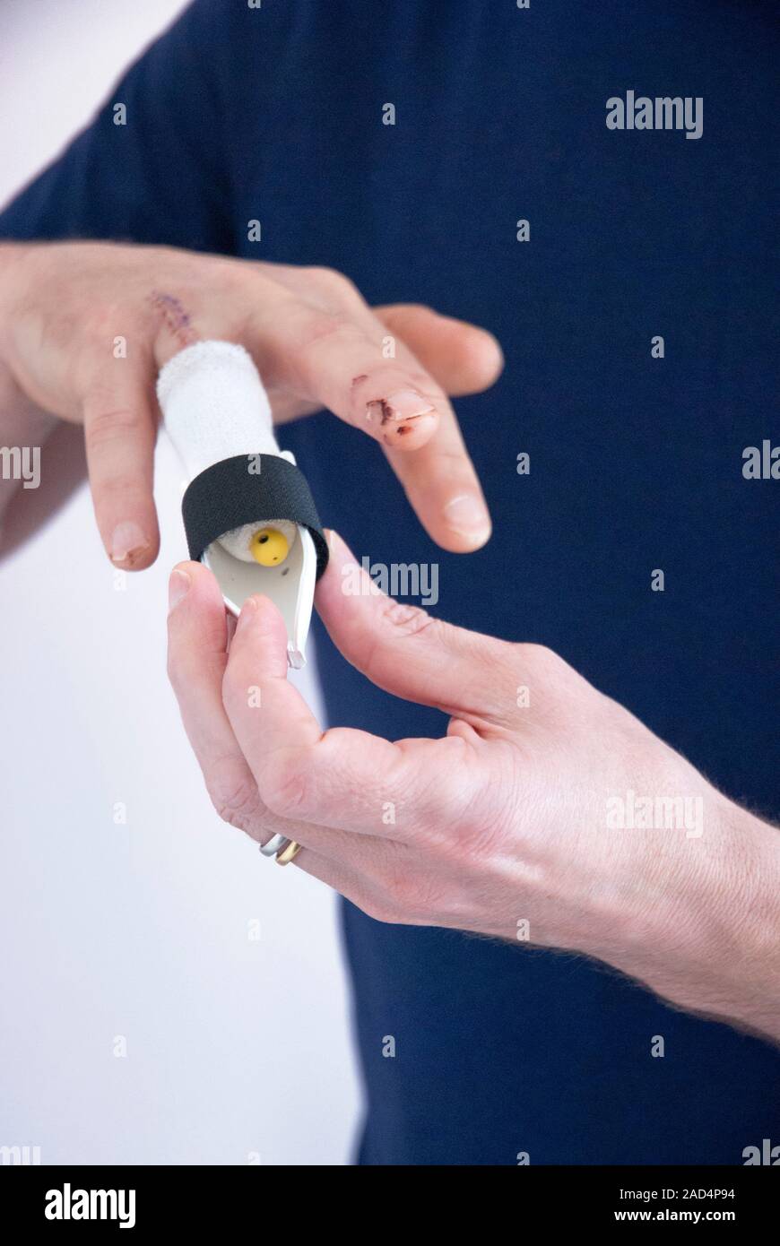 Pinned finger fracture. Man's bandaged fractured finger in a splint ...