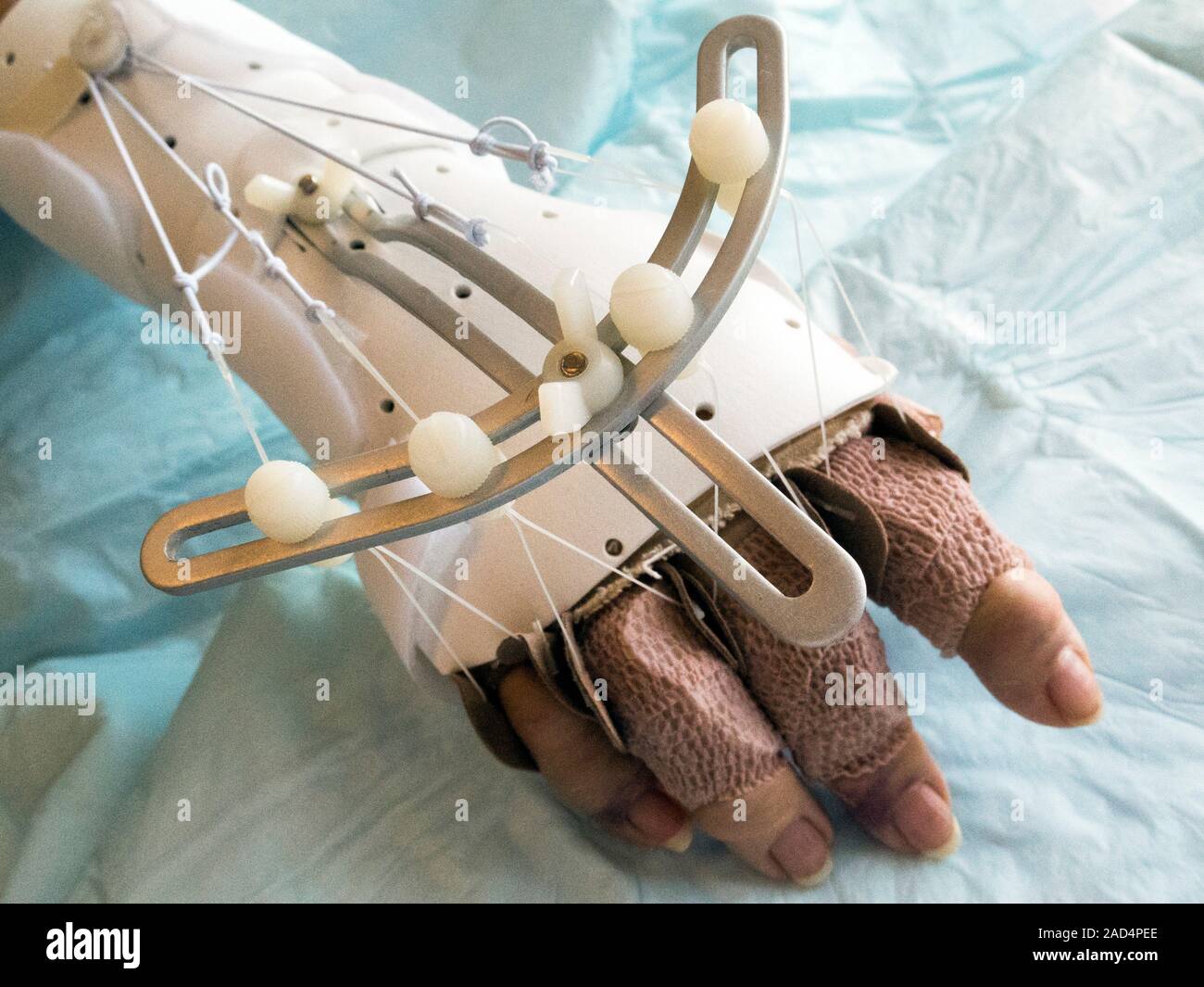 Hand Joint Replacement Close Up A Dorsiflexion Splint On A Patients