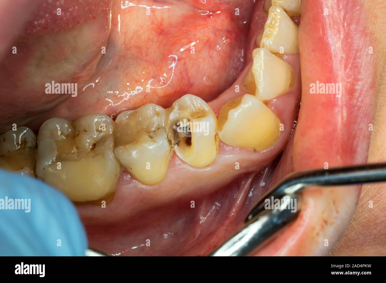 Root canal pulp extraction from premolar. Close-up of a premolar tooth ...
