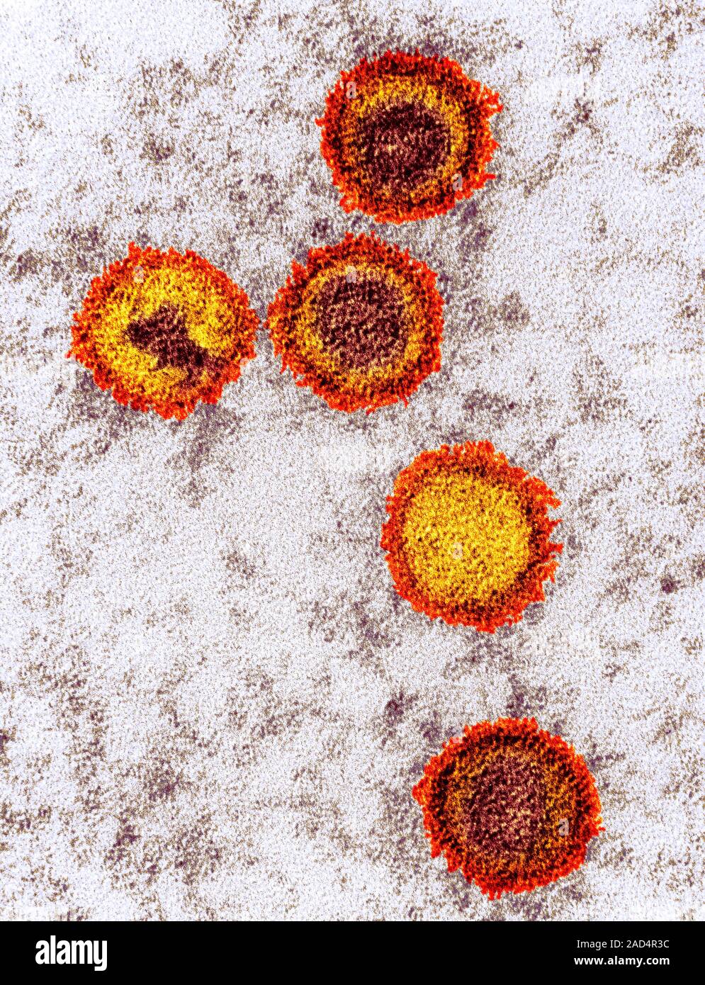 Coloured transmission electron micrograph (TEM) of Epstein-Barr virus (EBV) particles in Burkitt ...