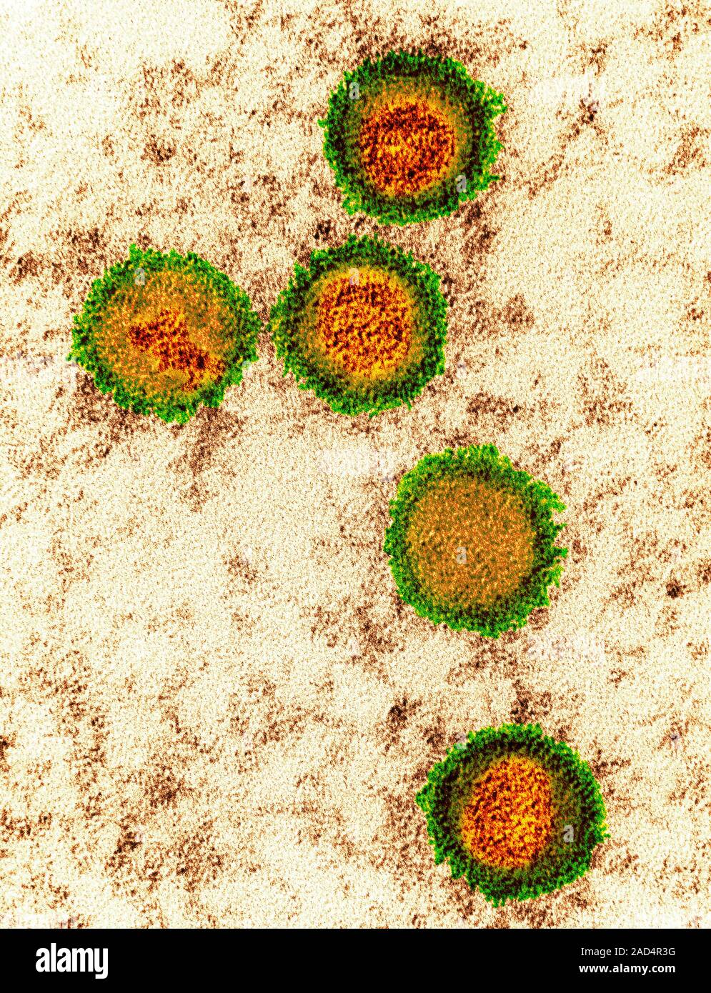 Coloured transmission electron micrograph (TEM) of Epstein-Barr virus (EBV) particles in Burkitt ...