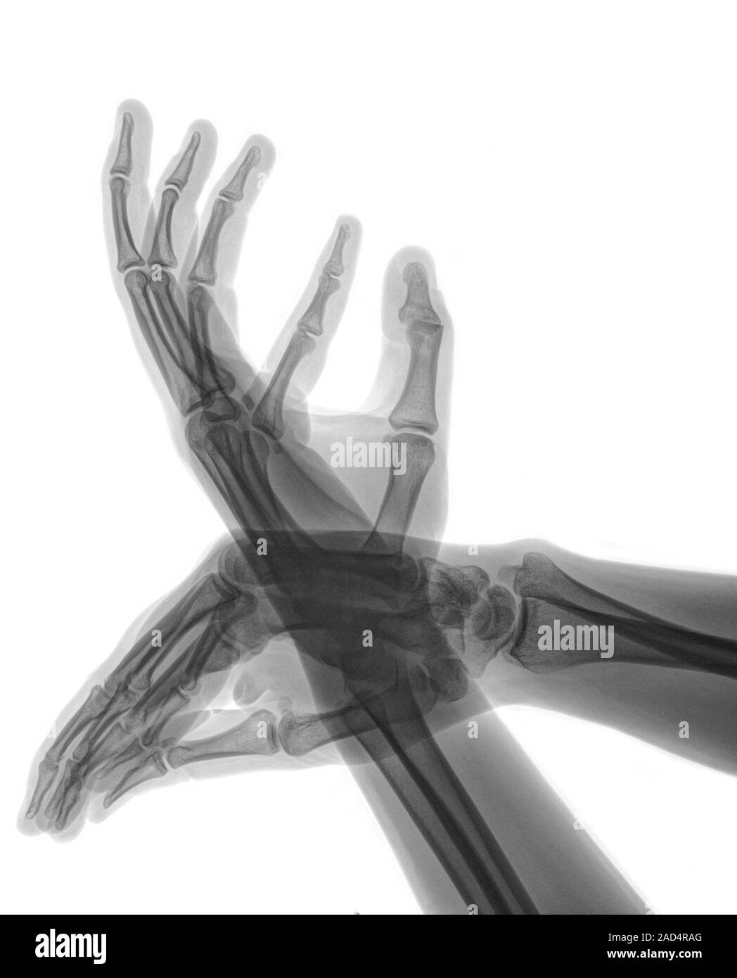 X-ray of hands Stock Photo - Alamy
