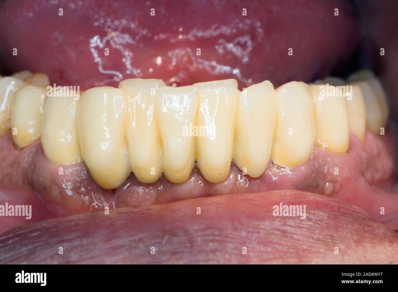 Dental metal-ceramic bridge. Close-up of the lower jaw of a 45-year old ...