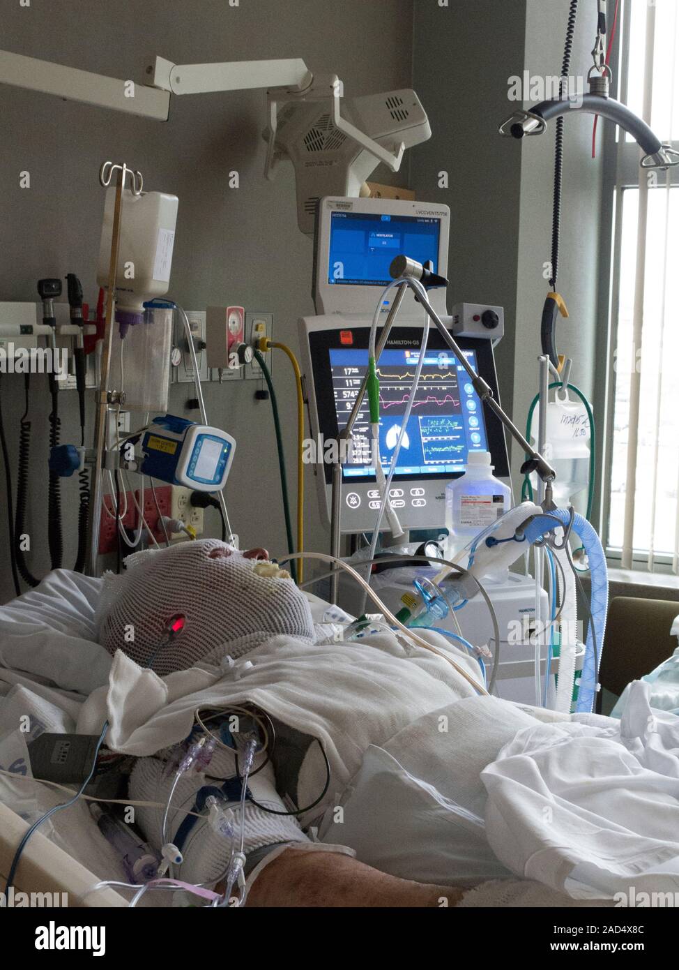 Toxic epidermal necrolysis patient in ICU. Patient with toxic epidermal ...