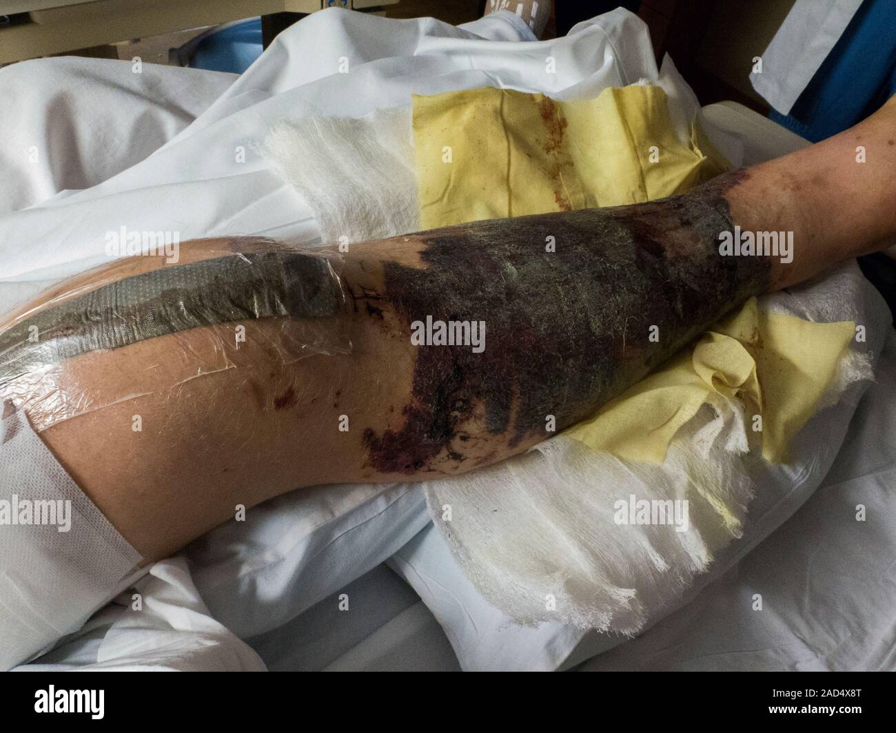 Cellulitis and necrosis following surgery. Close-up of the swollen and ...