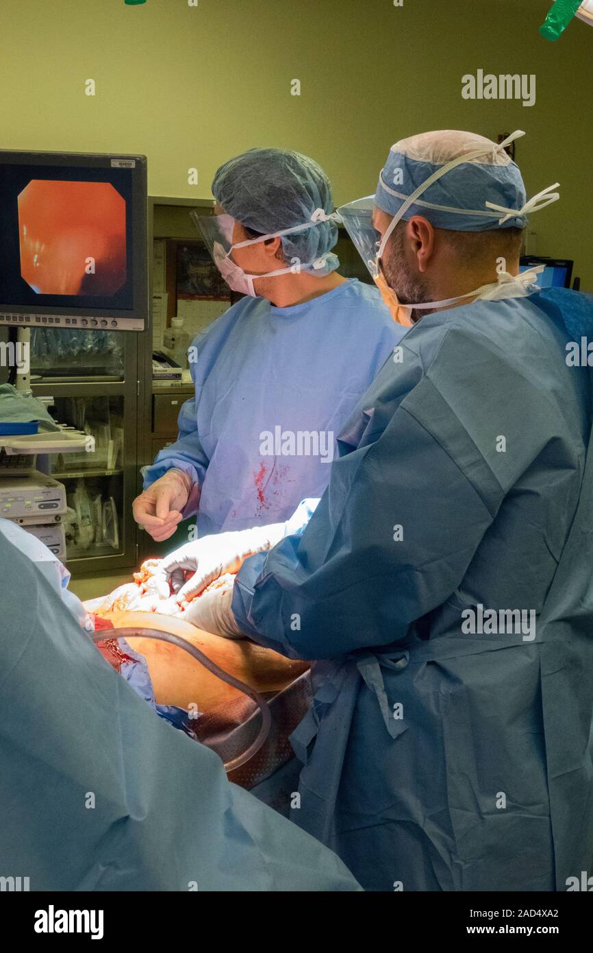 Bowel surgery in pneumoperitoneum. Surgeons performing an endoscopy ...