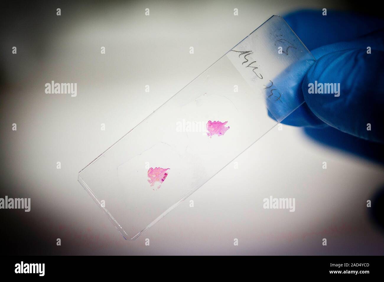 Test staining of cancerous biopsy tissue on a microscope slide ...