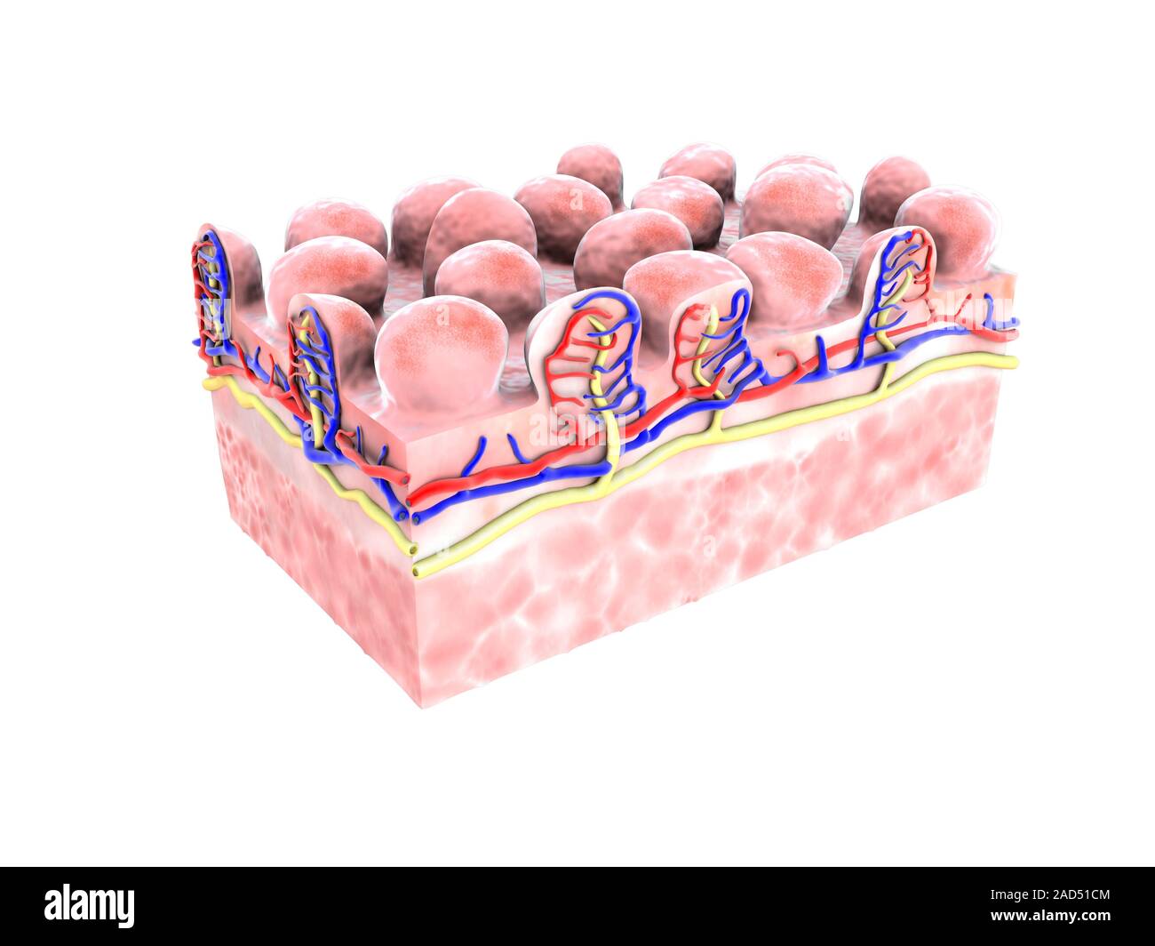 Intestinal villi in coeliac disease (gluten intolerance), illustration ...
