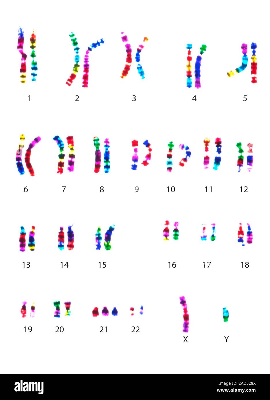 Down's syndrome. Coloured karyotype of the chromosomes in a male with ...